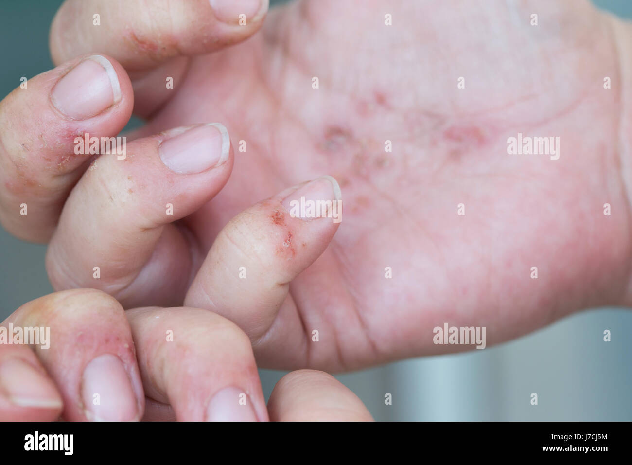 Hands of an adult woman with a problem of dermatitis Stock Photo - Alamy