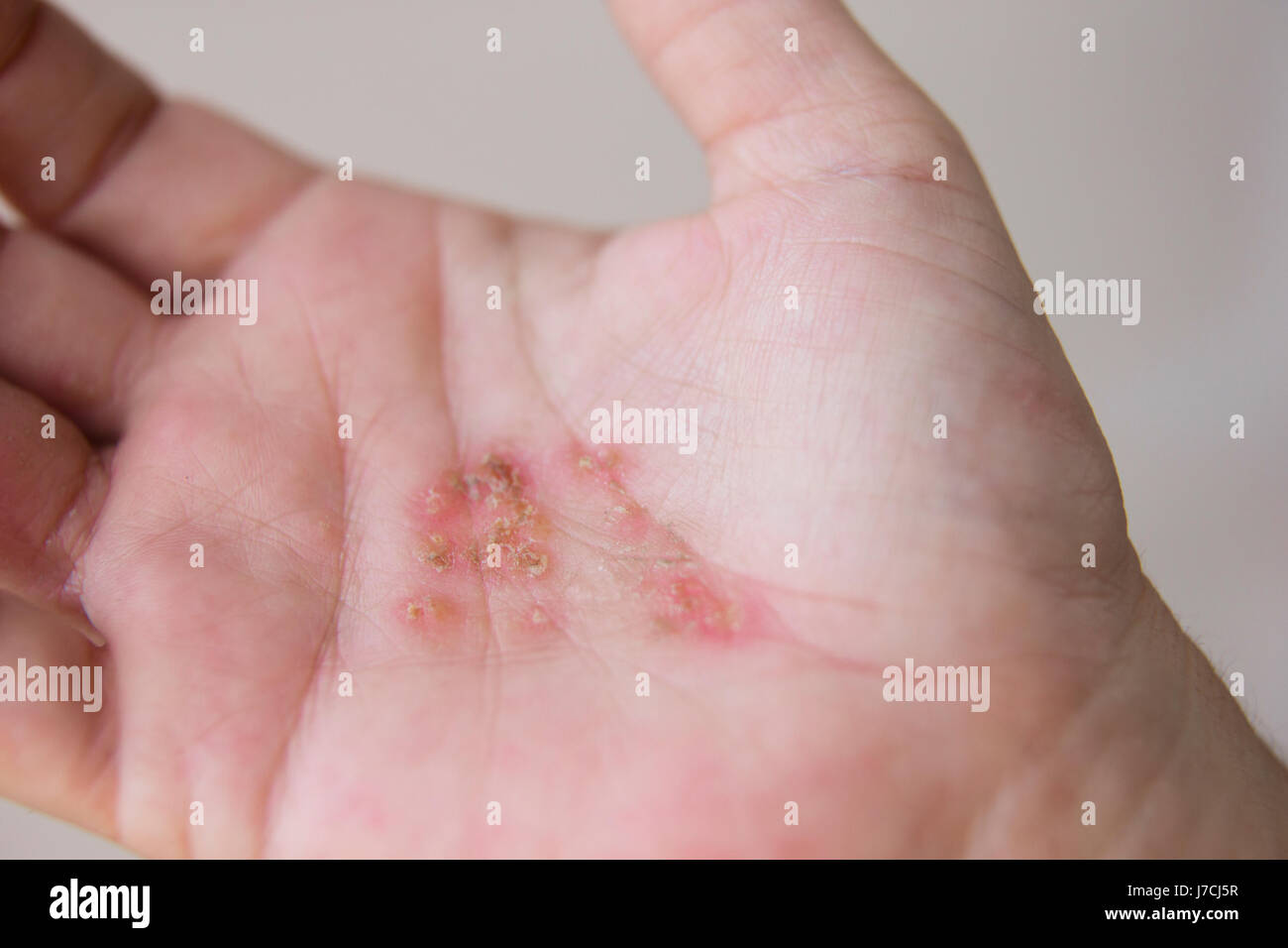 Atopic dermatitis hands hi-res stock photography and images - Alamy