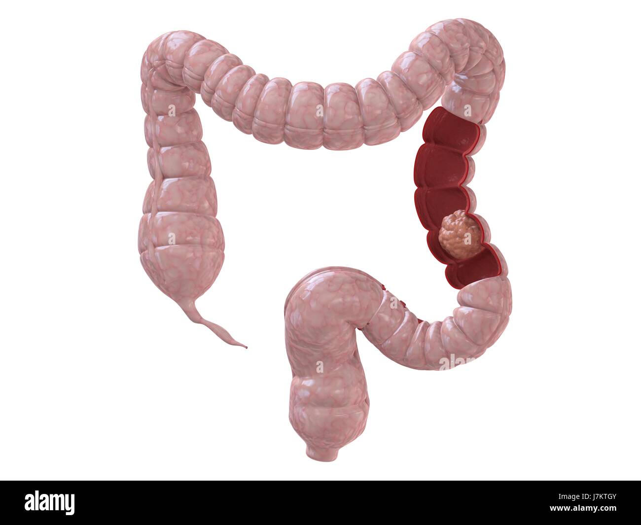 Stomach polyp hi-res stock photography and images - Alamy