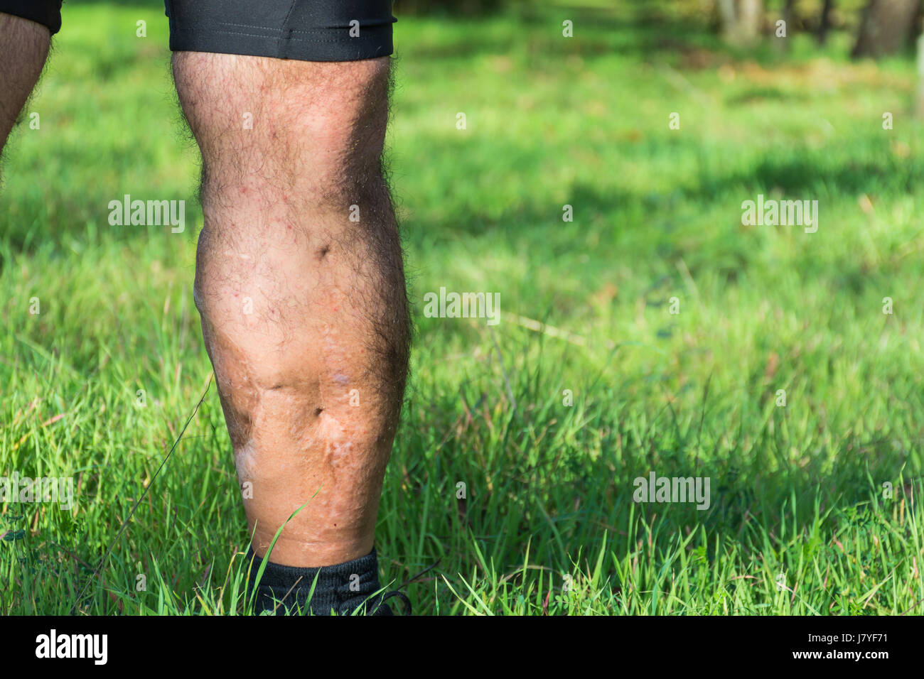 Old scar of leg injury, from car or motorbike accident, deep tissue ...