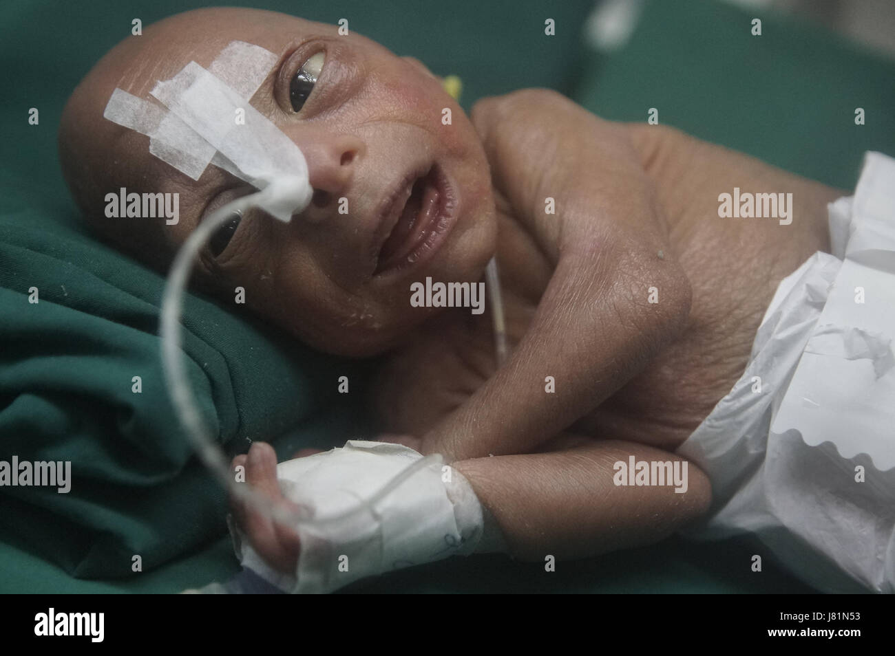 Hutchinson gilford progeria syndrome hi-res stock photography and ...