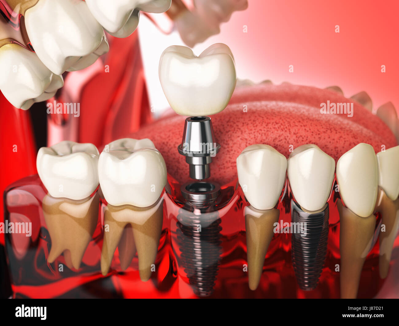 Tooth implant in the model human teeth, gums and denturas. Dental ...