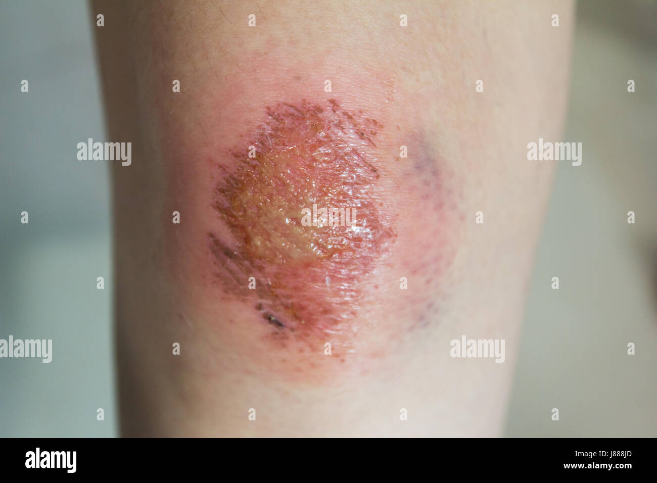 Fresh wound with lymph and blood on asian female knee background Stock ...