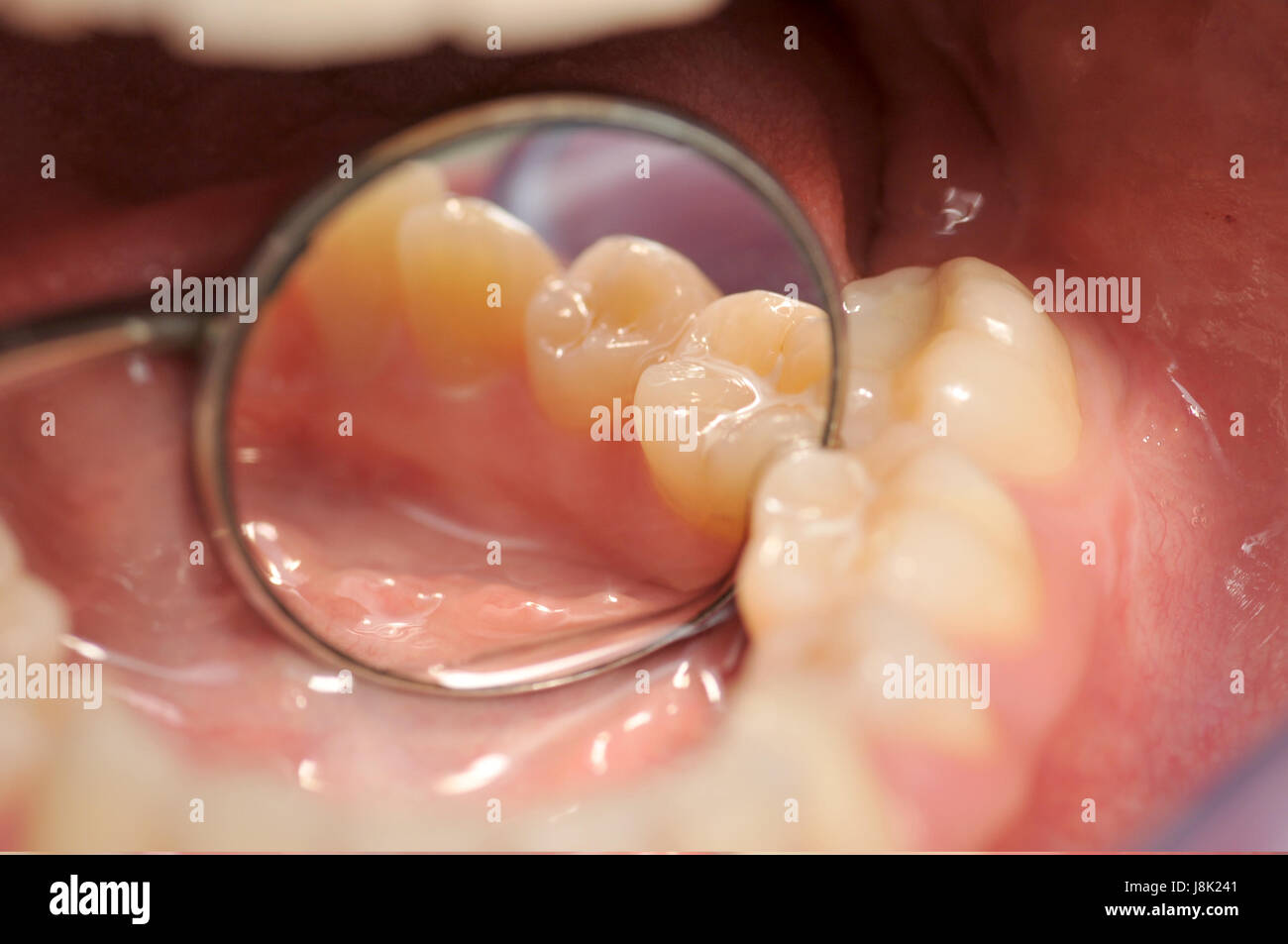 mouth, teeth, dentist, pine, tooth, treatment, dentistry, dental ...