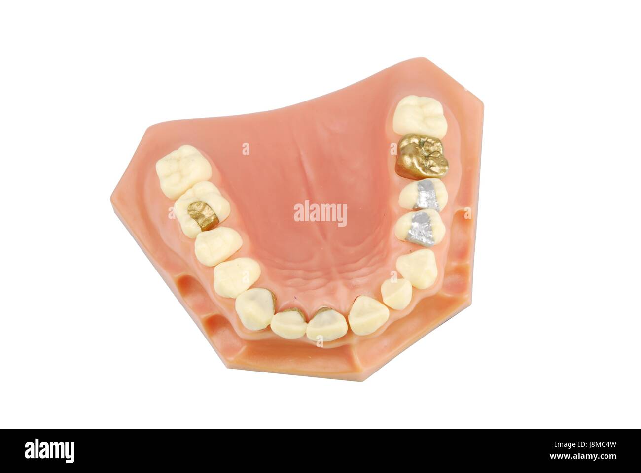 teeth, treatment, porcelain, crown, dental, gold, jagged, some, several ...