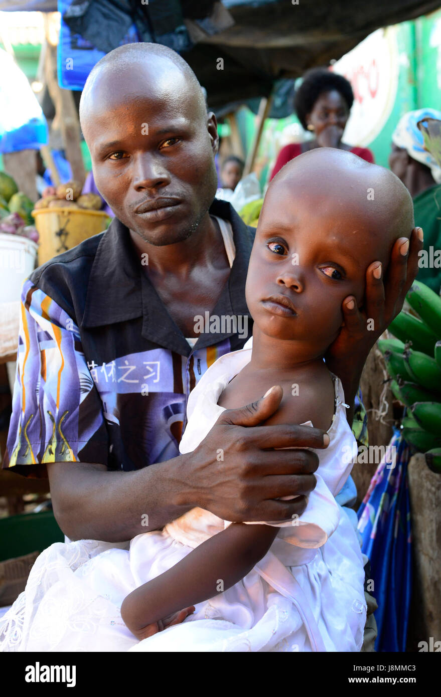 Hydrocephalus In Children