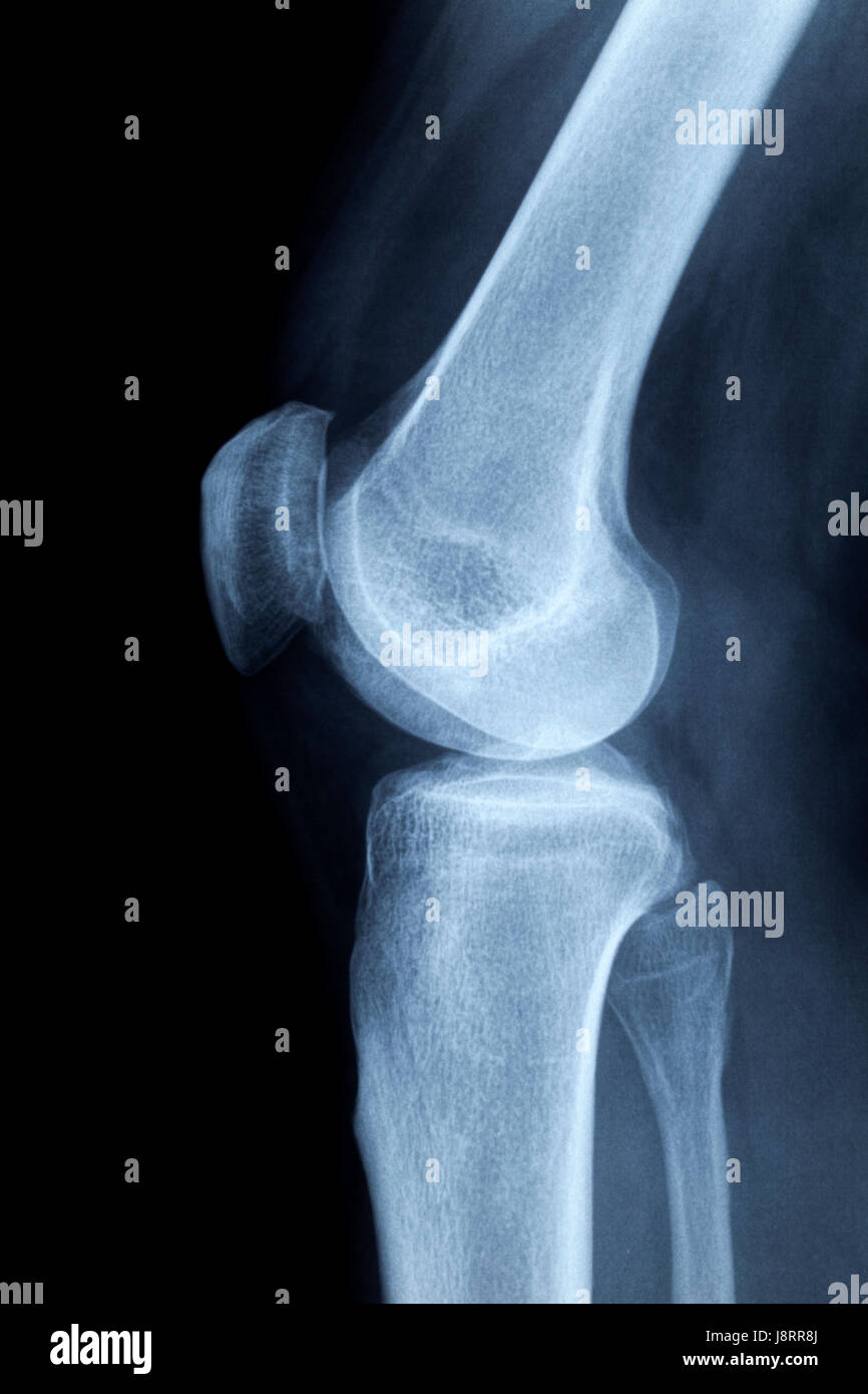 Normal knee x ray hi-res stock photography and images - Alamy