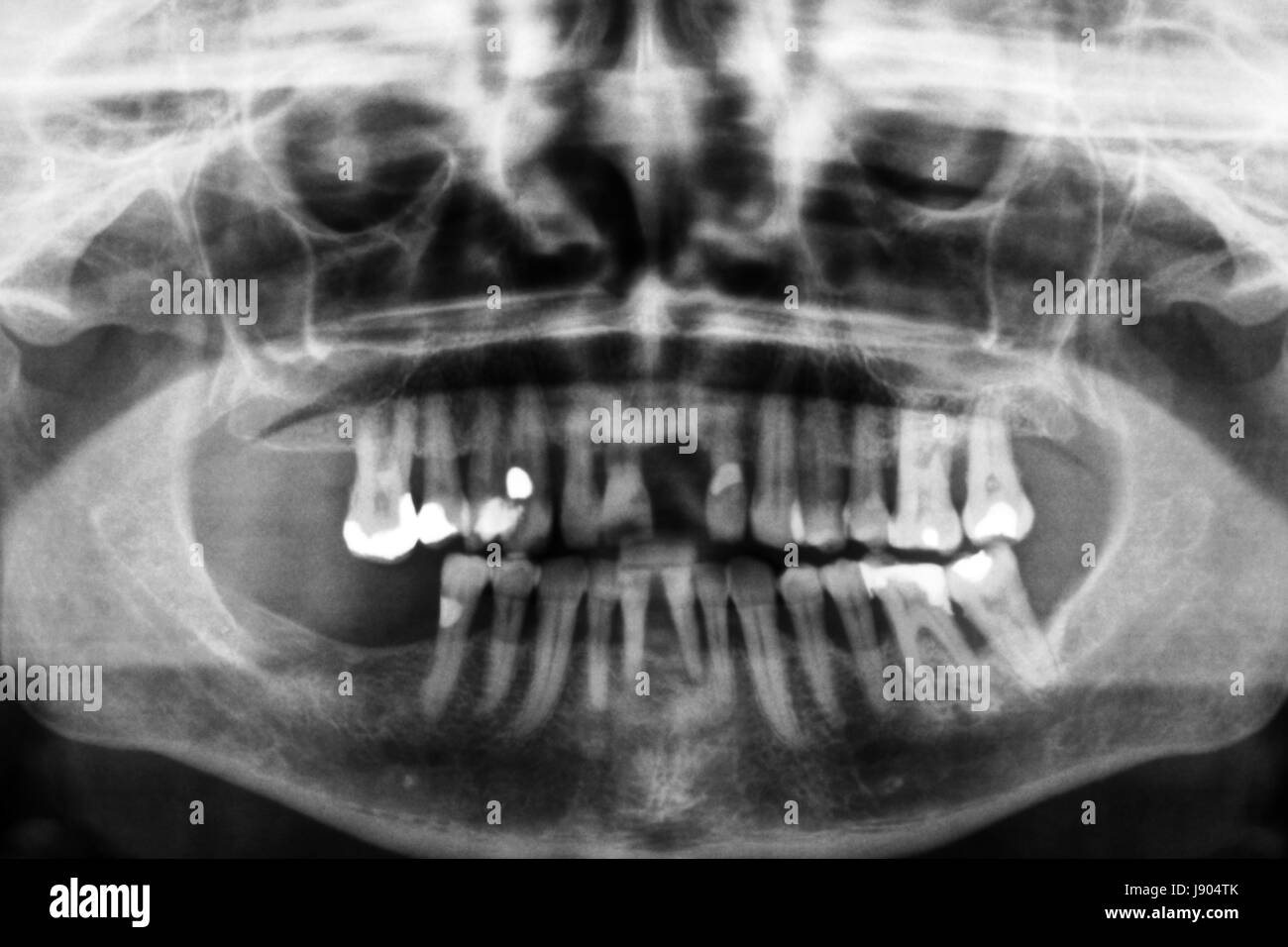 Lower jaw human teeth Black and White Stock Photos & Images - Alamy