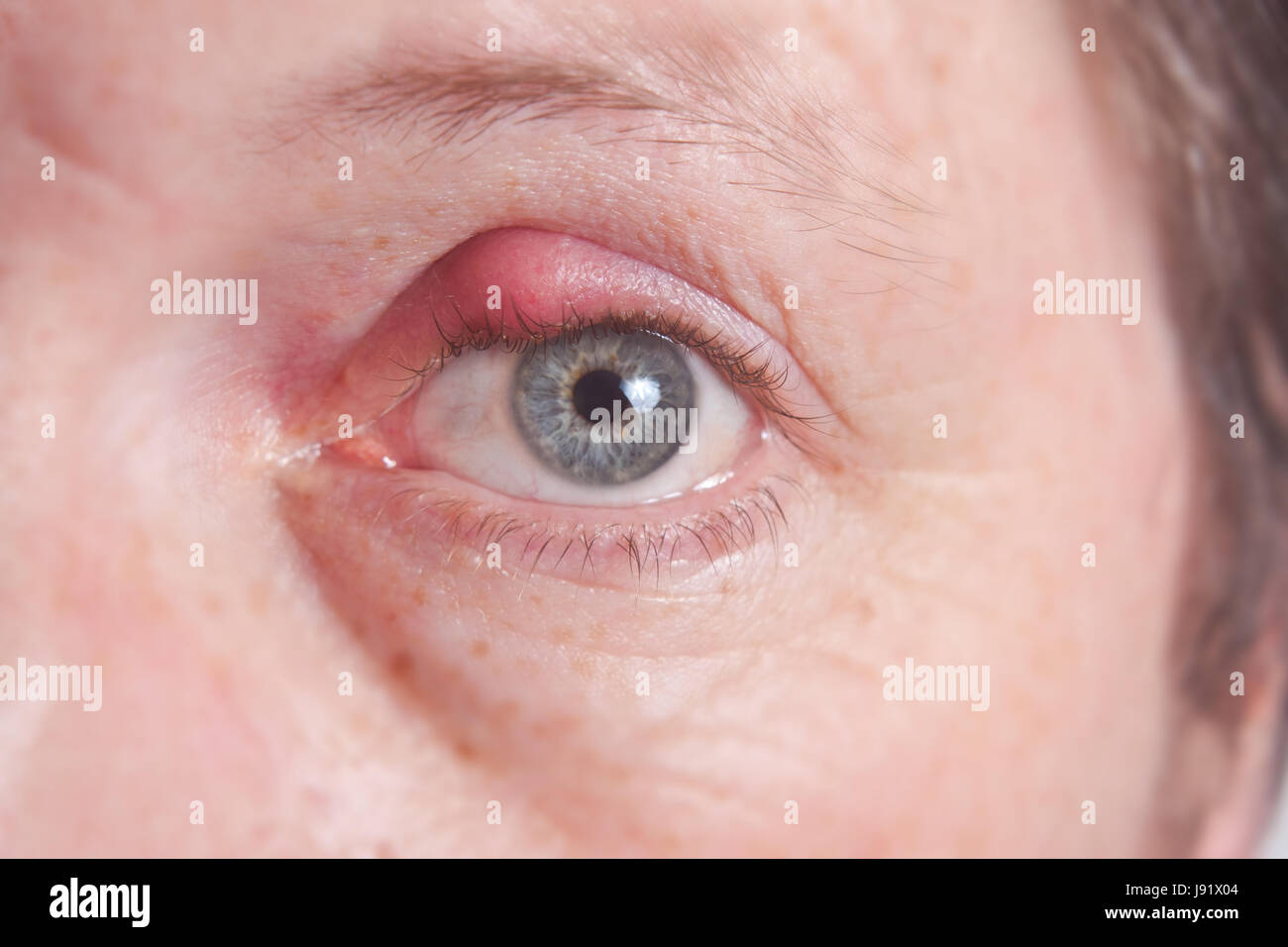Stye eye hi-res stock photography and images - Alamy