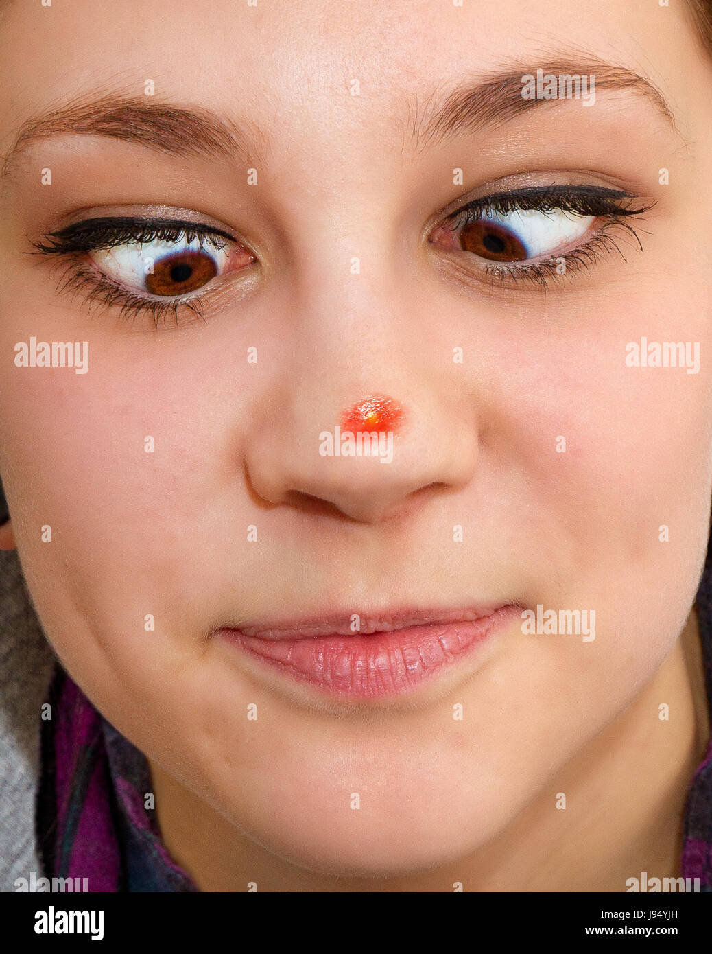 large pimples on the nose Stock Photo - Alamy