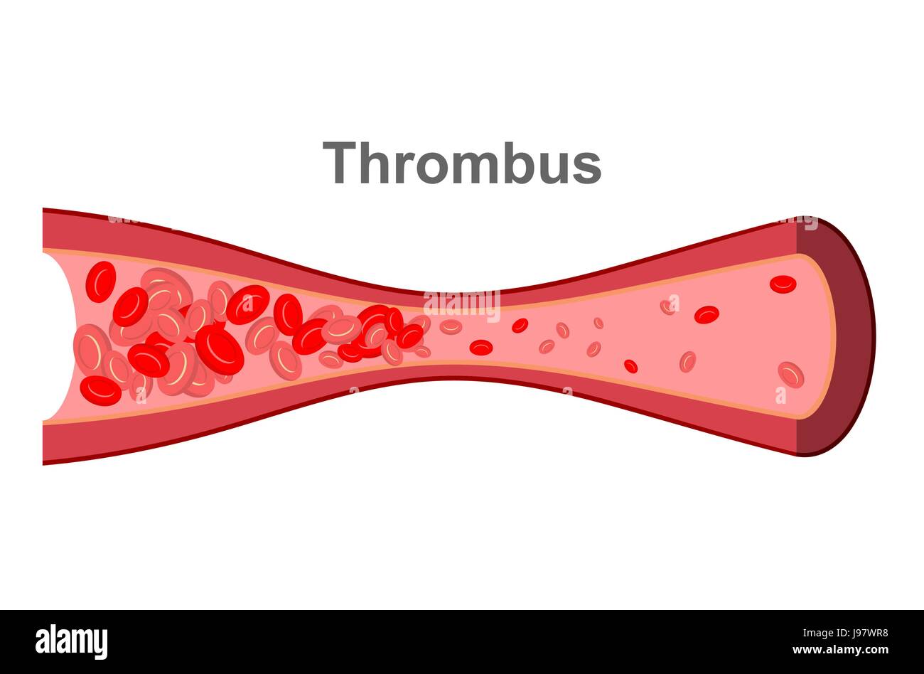 Blood clot in heart Cut Out Stock Images & Pictures - Alamy