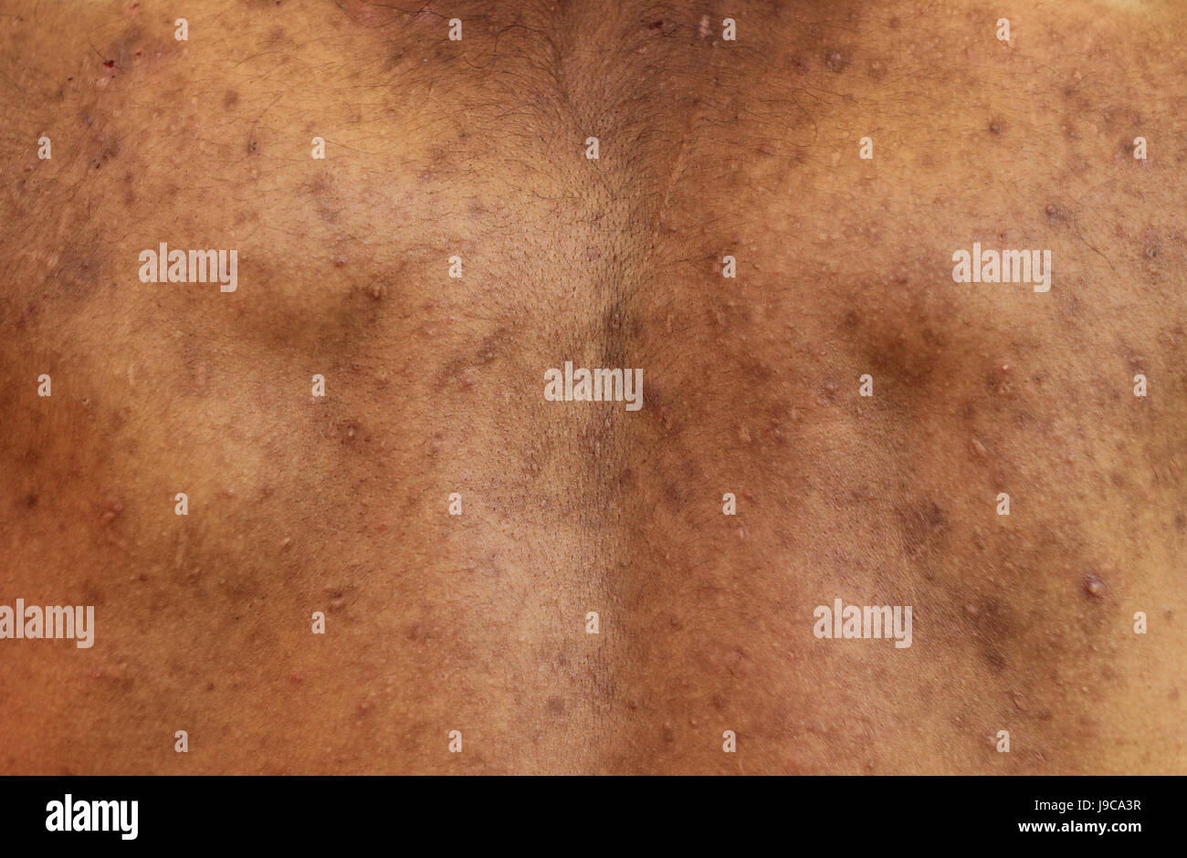 Acne on the back Stock Photo - Alamy