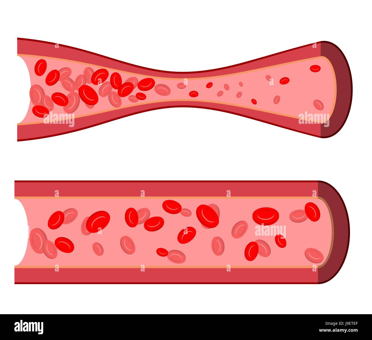 Bloody artery. Blockage of blood vessels. Sick artery with leukocytes ...