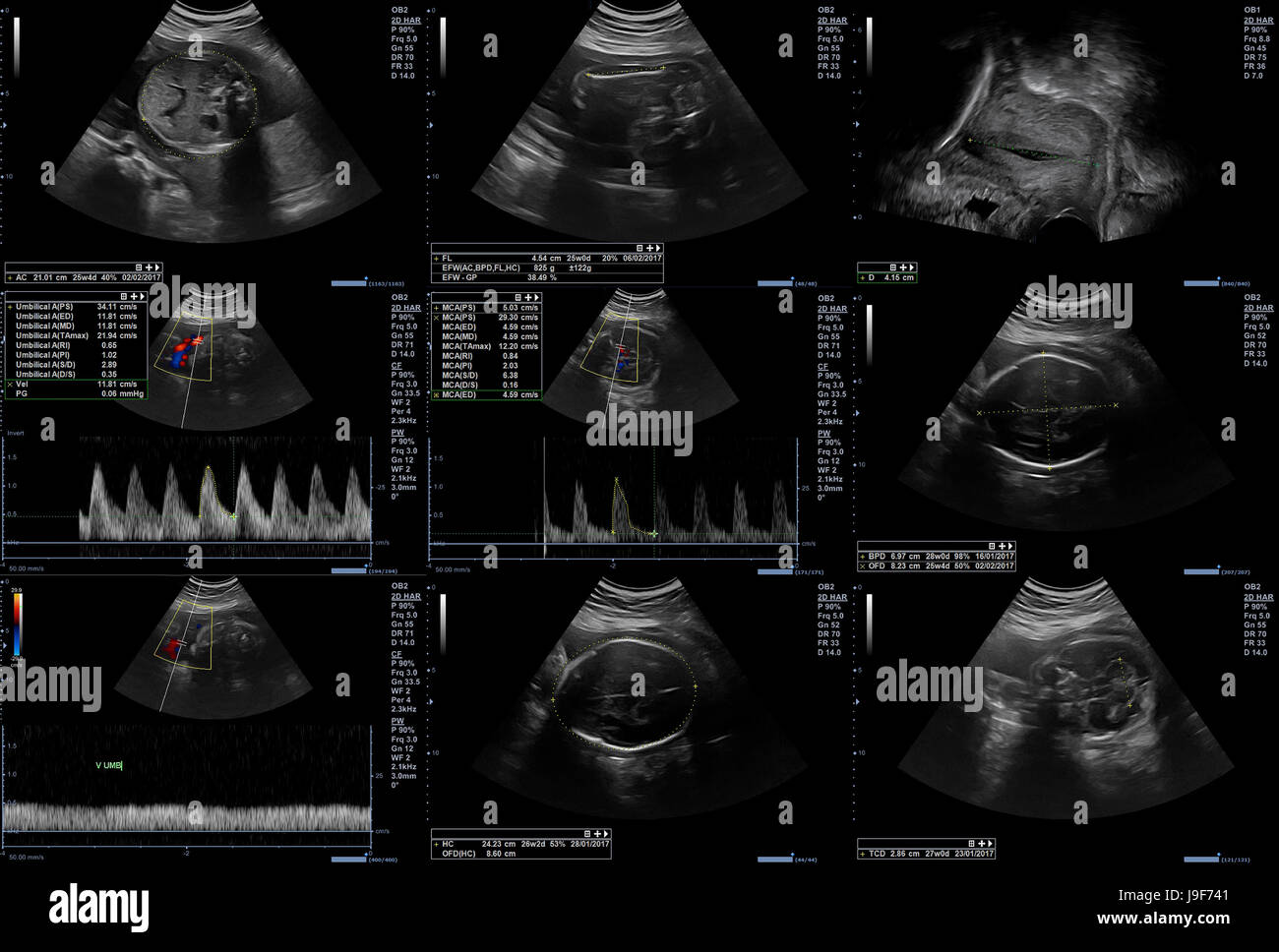 Collage of 9 ultrasonography fetus pictures Stock Photo - Alamy
