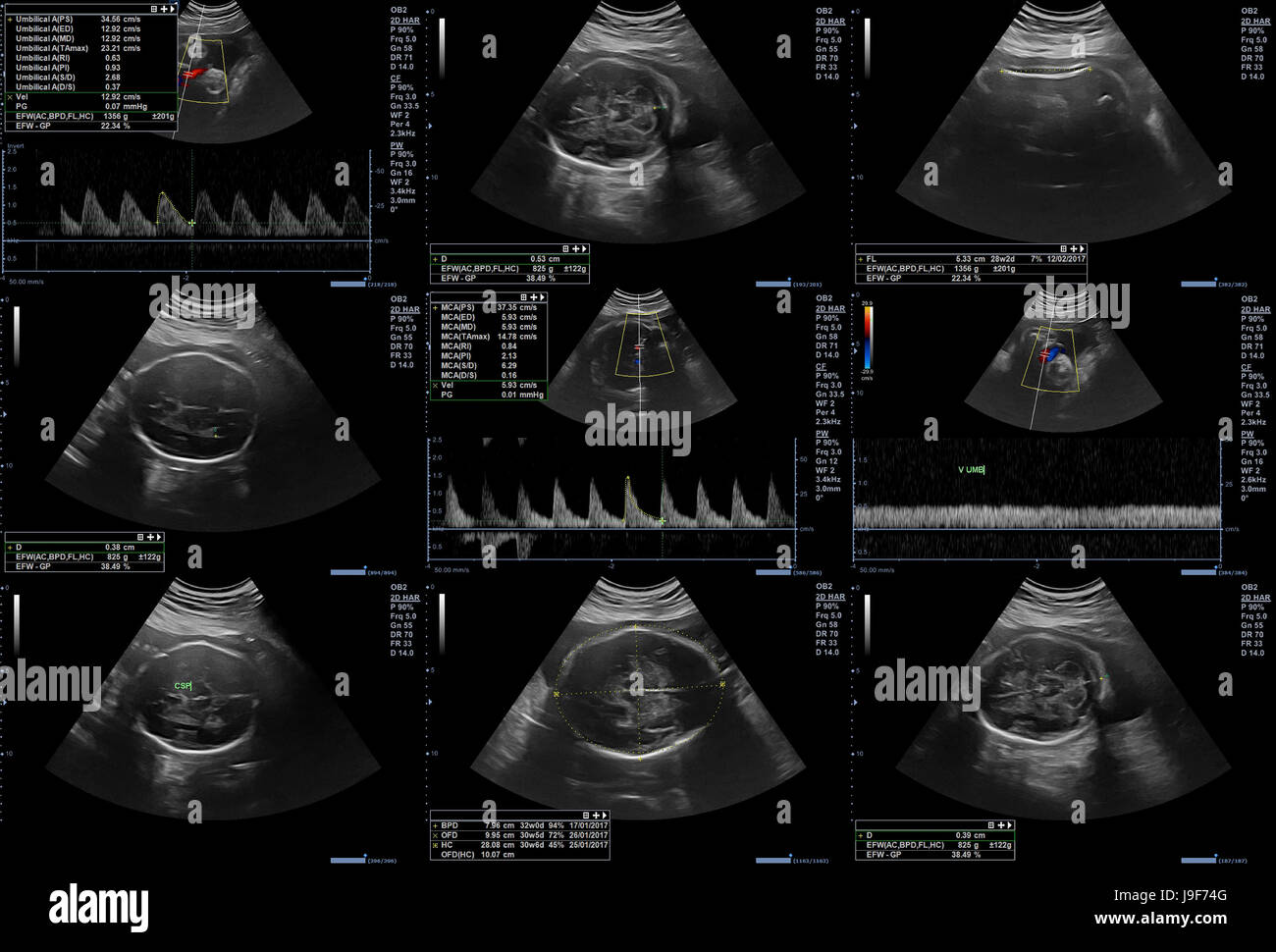 Placenta Human Scan High Resolution Stock Photography and Images - Alamy