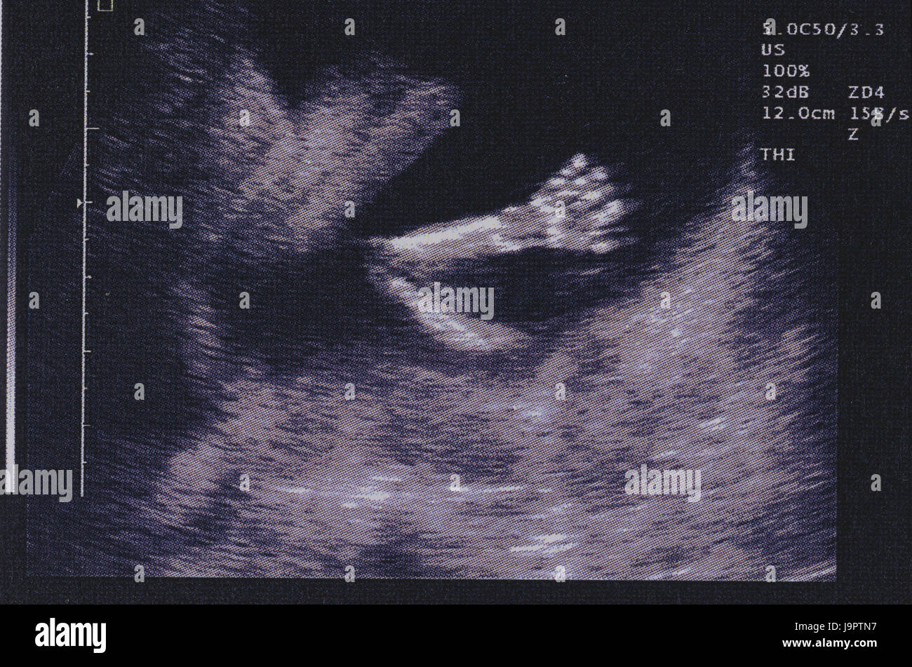 Gestation,ultrasound recording,foetus,humanely,detail,arm,s/w medicine ...