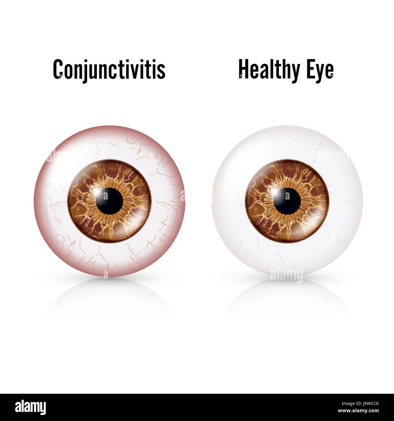 Conjunctivitis. Red Eye. Healthy Eye And Eyeball with Conjunctivitis ...