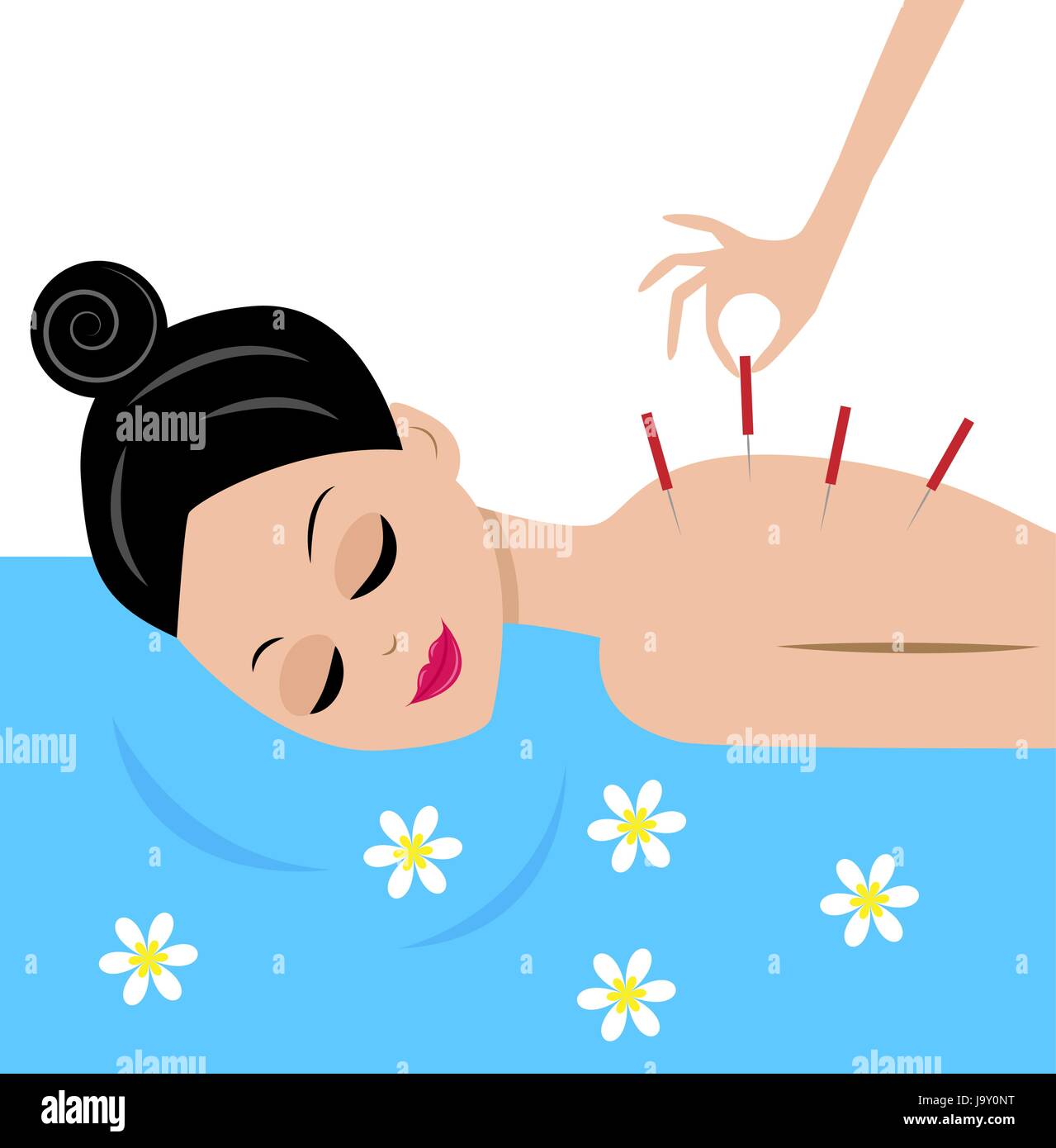 young woman accept procedure acupuncture, vector illustration Stock ...