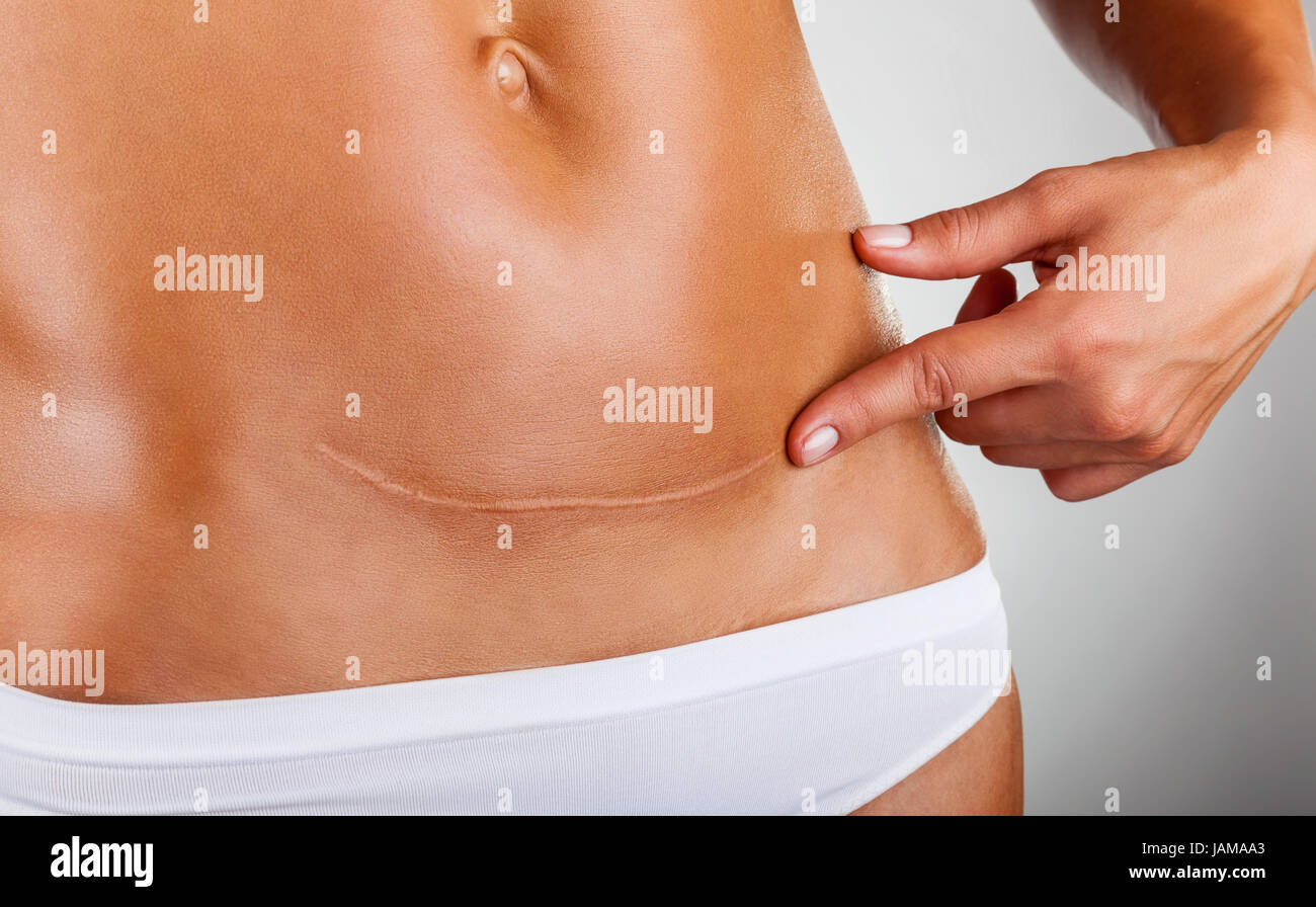 Cesarean section hi-res stock photography and images - Alamy