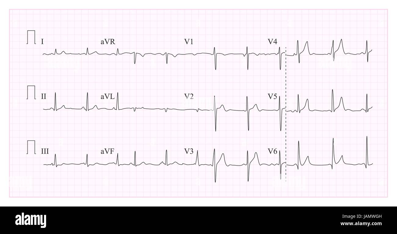 Heart Cardiogram Chart Vector. Illustration Of Wave Form On Checked Ecg ...