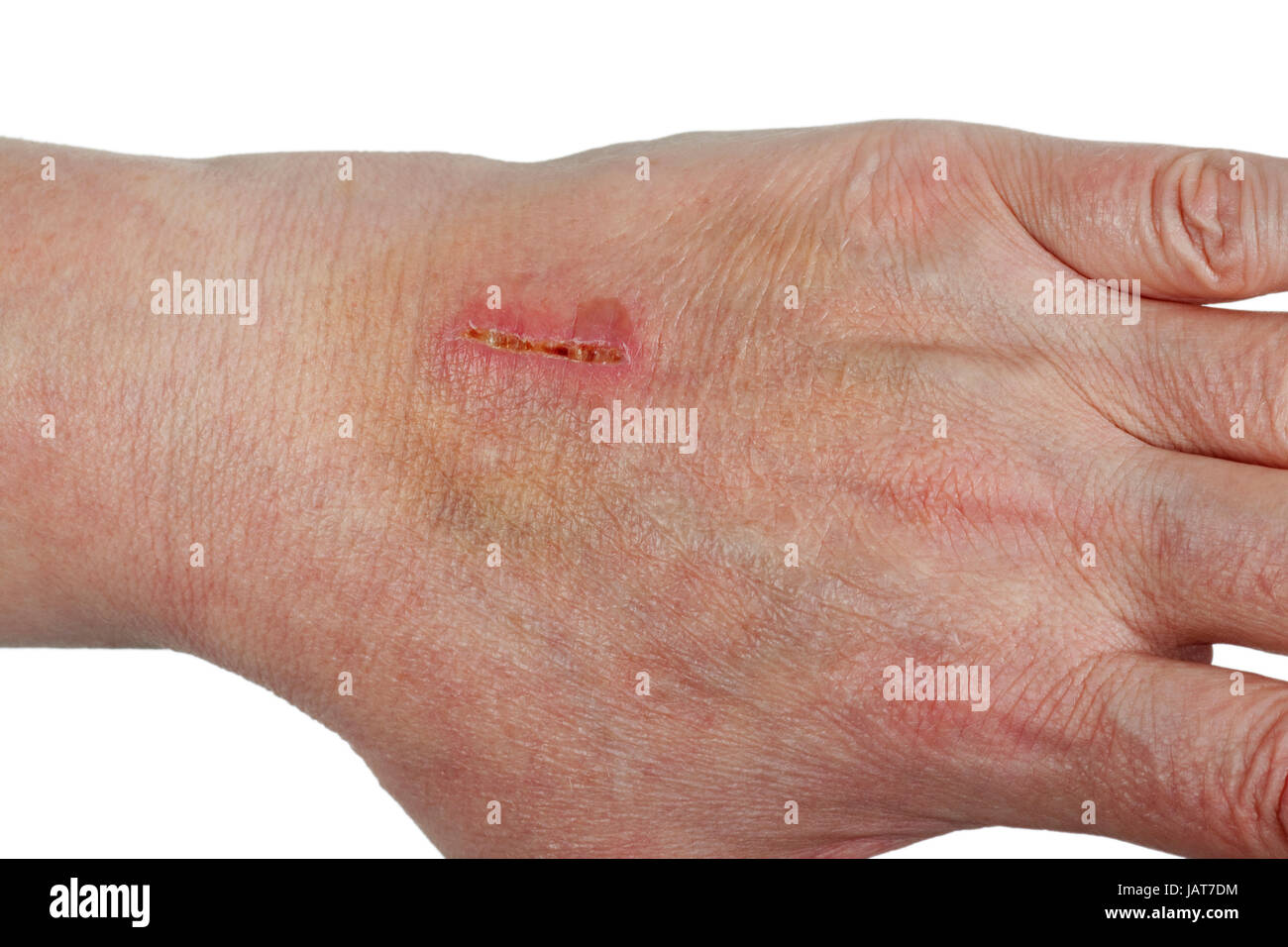 Hand laceration hi-res stock photography and images - Alamy