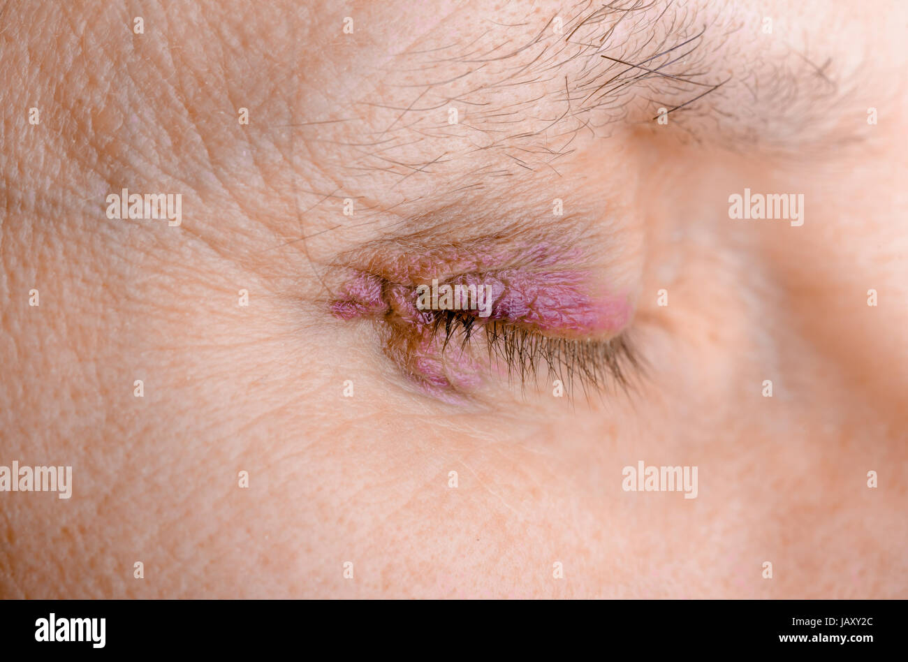 Inflammation blood vessels hi-res stock photography and images - Alamy