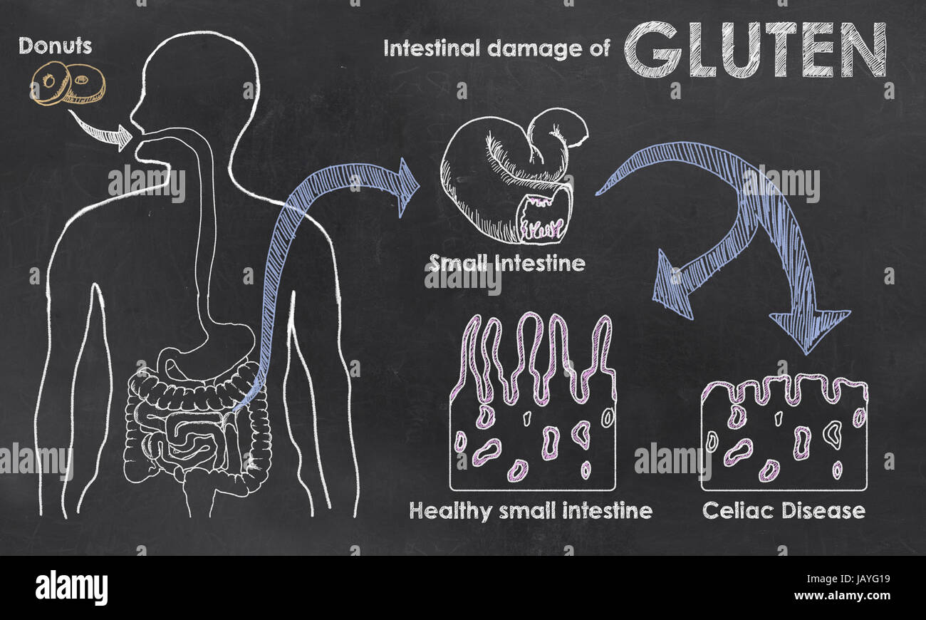 Celiac Intestine High Resolution Stock Photography and Images - Alamy