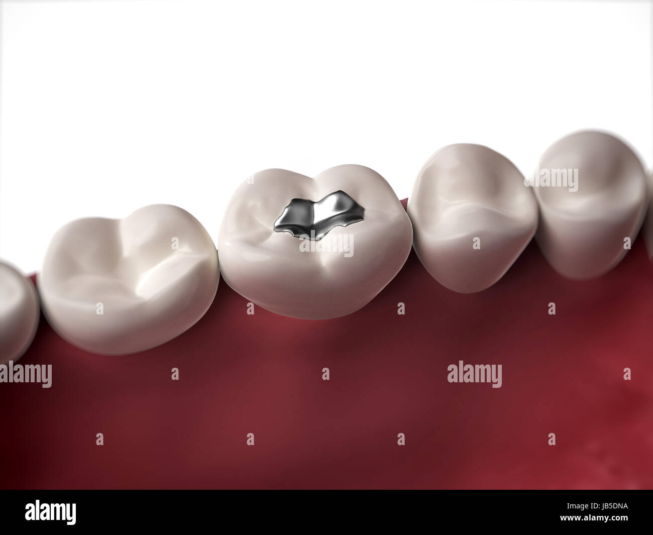 3d rendered illustration of an amalgam filling Stock Photo - Alamy