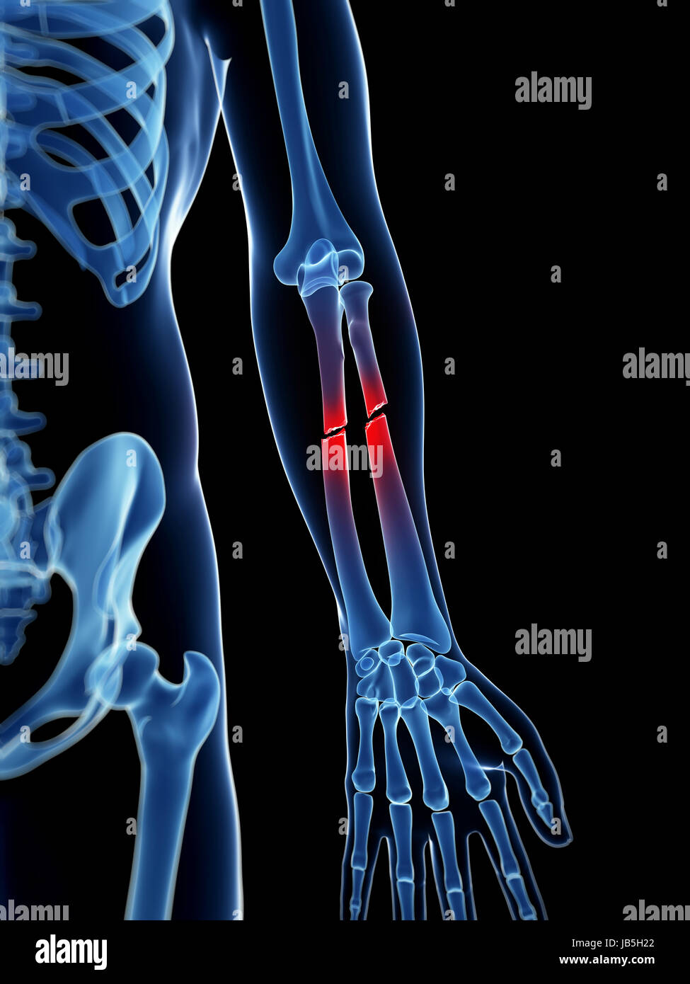 Lower arm bone hi-res stock photography and images - Alamy