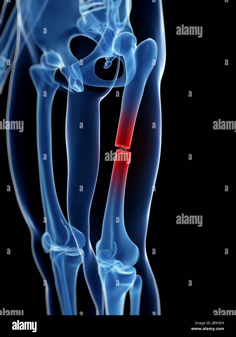 X ray fractured femur hi-res stock photography and images - Alamy
