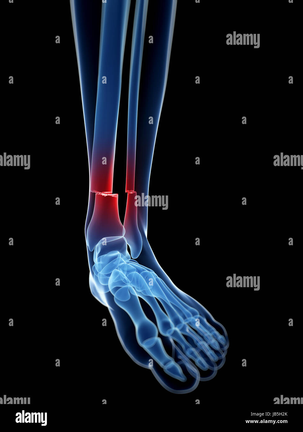 Tibia fracture illustration hi-res stock photography and images - Alamy