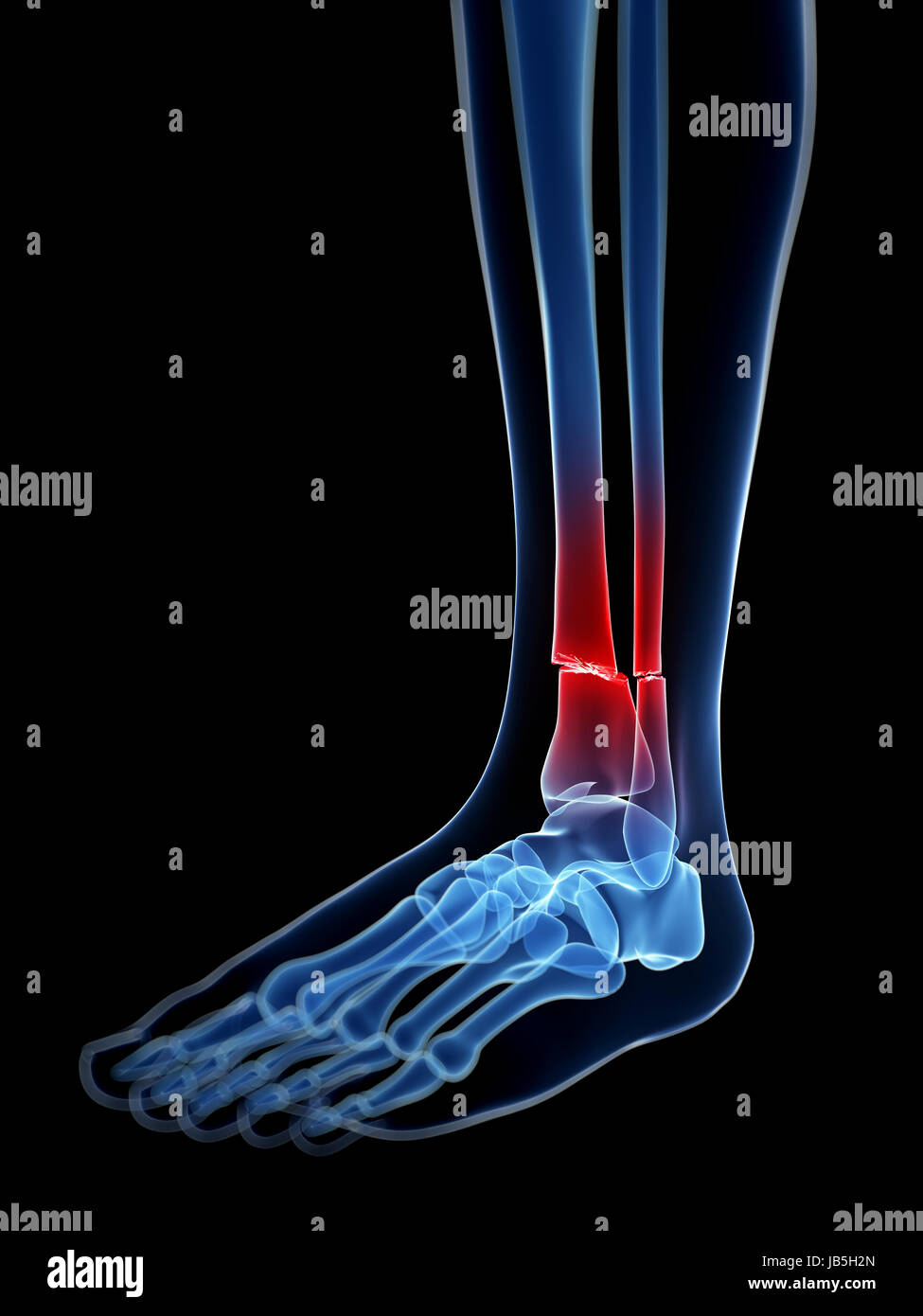 Lower leg fracture x ray hi-res stock photography and images - Alamy