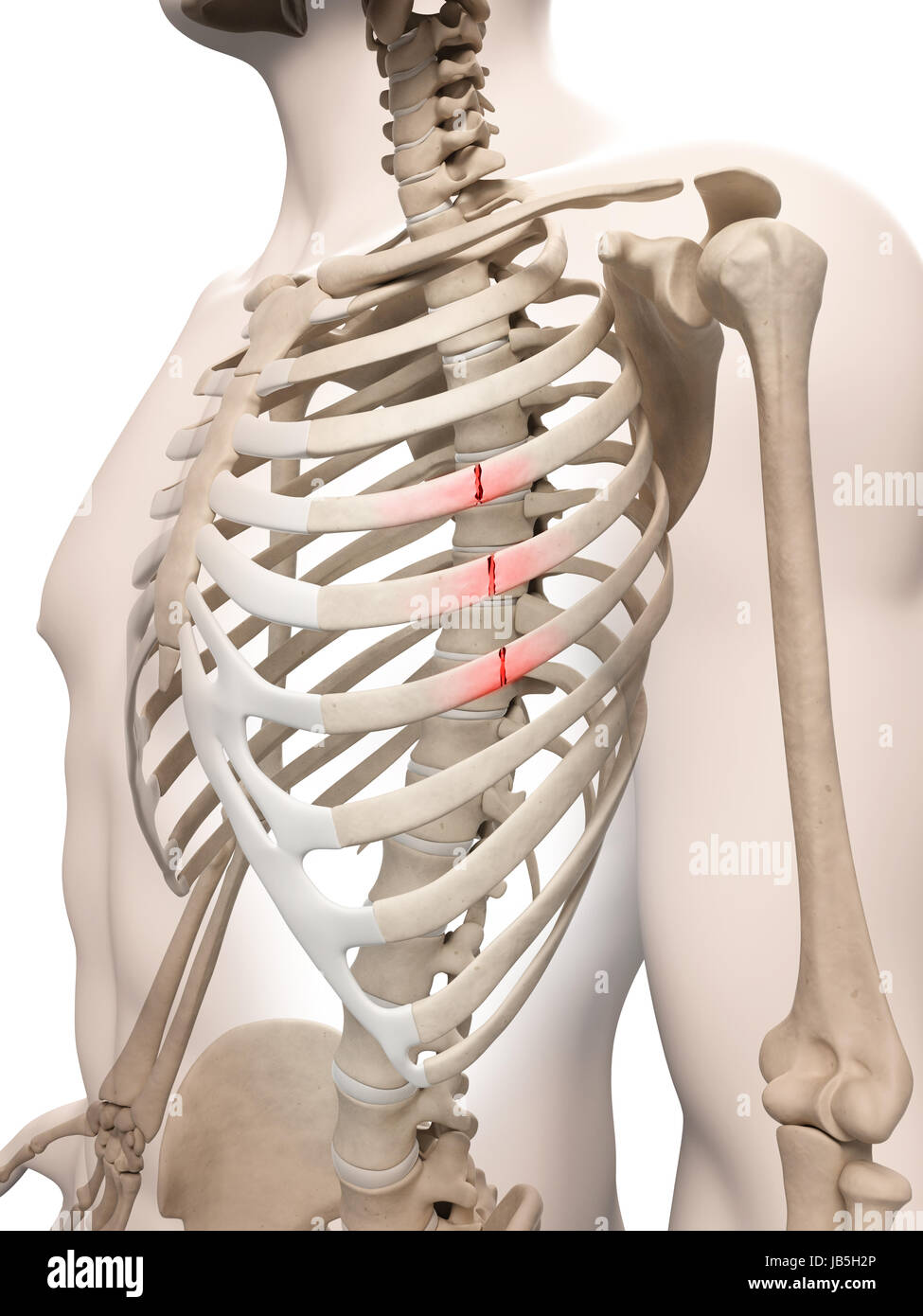 Broken ribs hi-res stock photography and images - Alamy