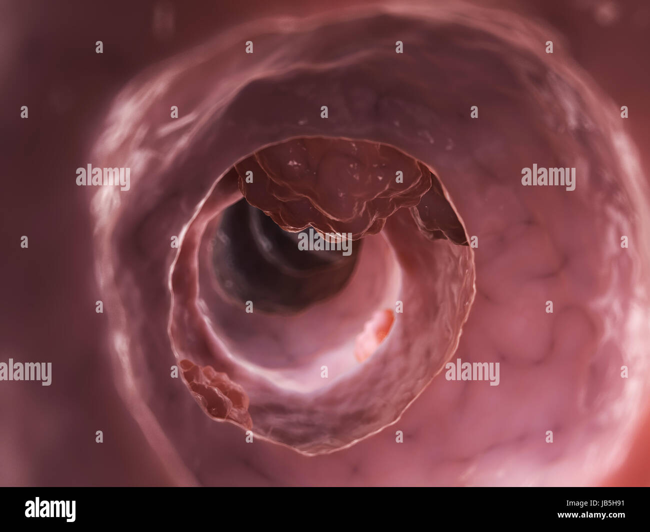 3d rendered illustration of a colon tumor Stock Photo - Alamy