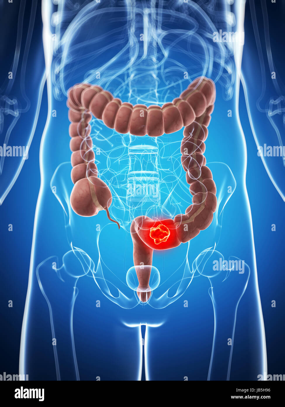 3d rendered illustration of the male colon - cancer Stock Photo - Alamy