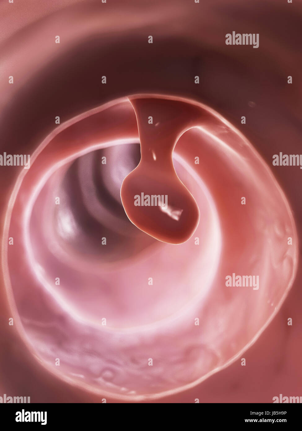 Colon polyp hi-res stock photography and images - Alamy