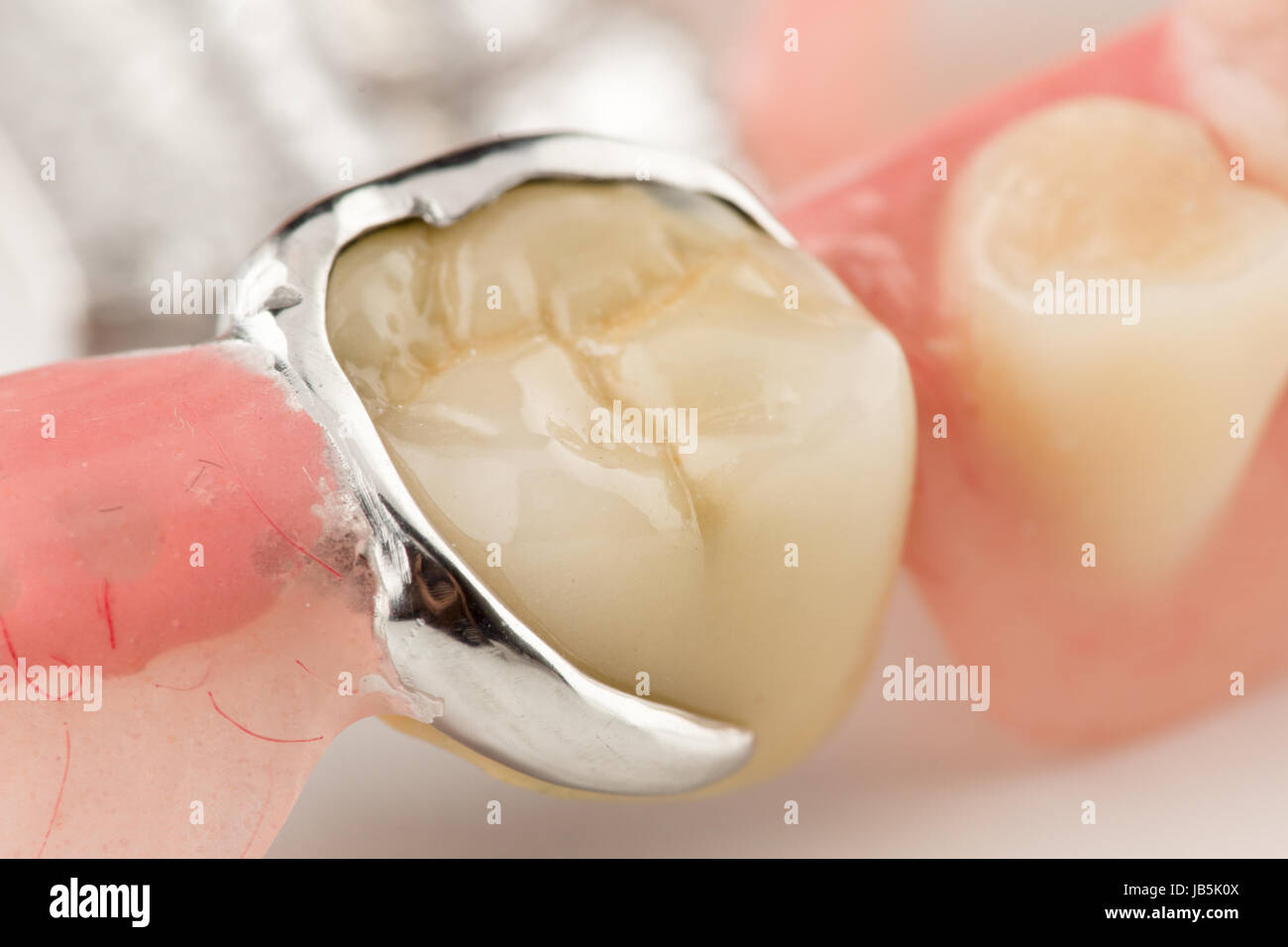 Clasp prosthesis with lock fixation on a white background Stock Photo ...