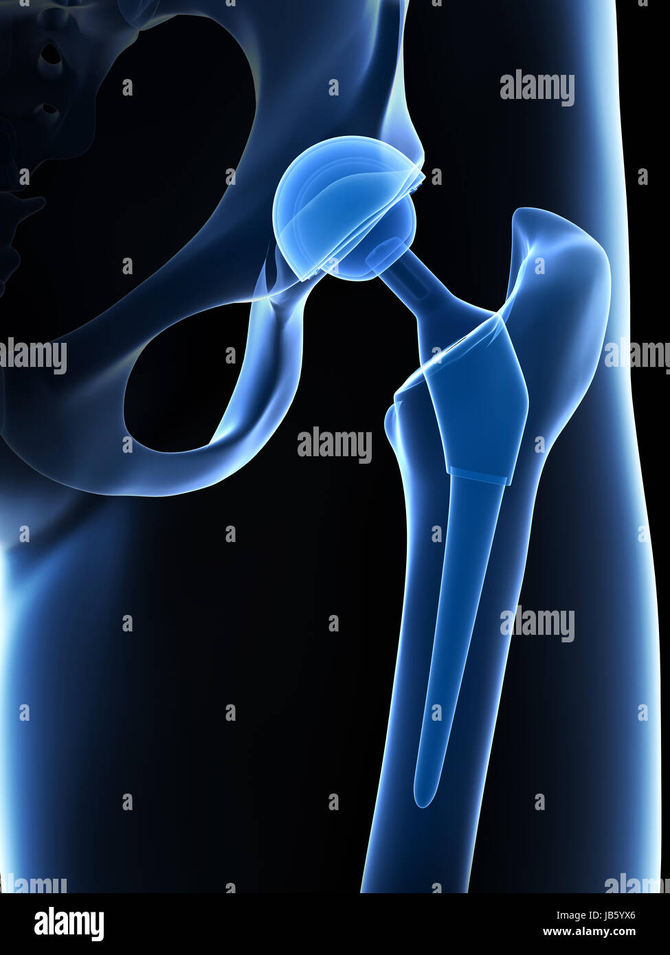 Total hip replacement hi-res stock photography and images - Alamy