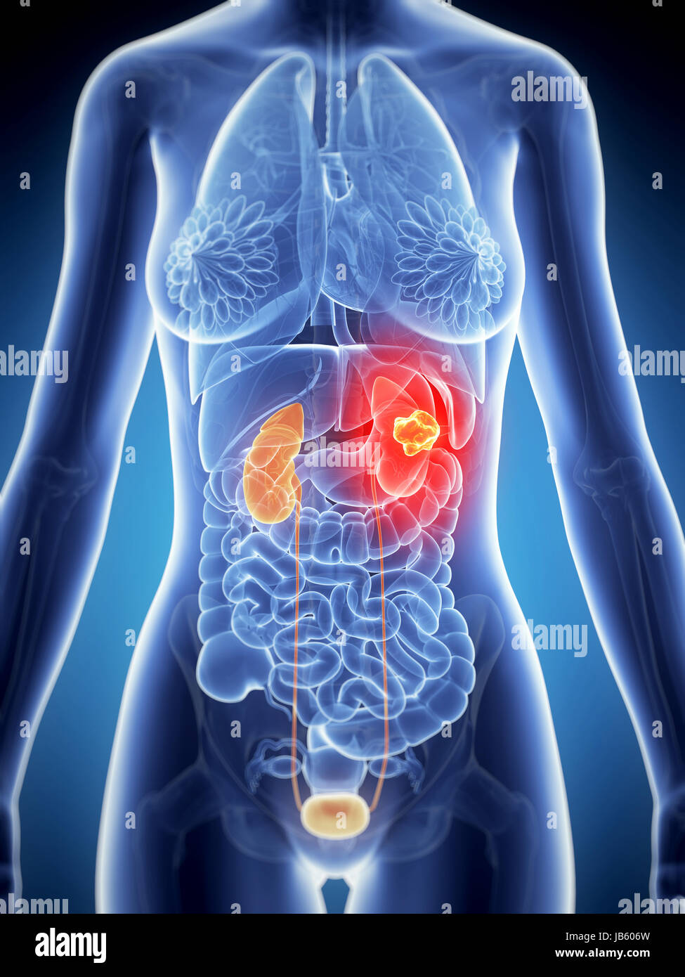 3d rendered illustration of female kidney cancer Stock Photo - Alamy