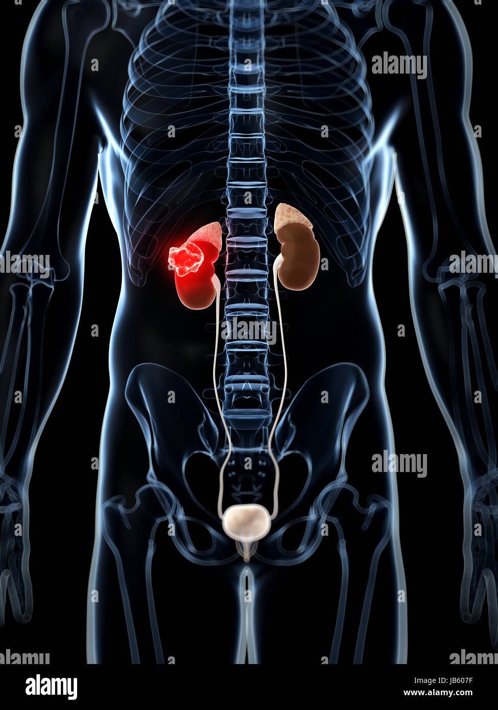 Bladder cancer male hi-res stock photography and images - Alamy