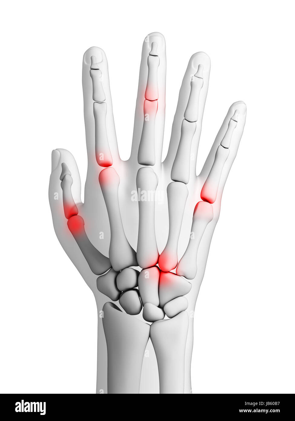 3d rendered illustration - arthritis Stock Photo - Alamy