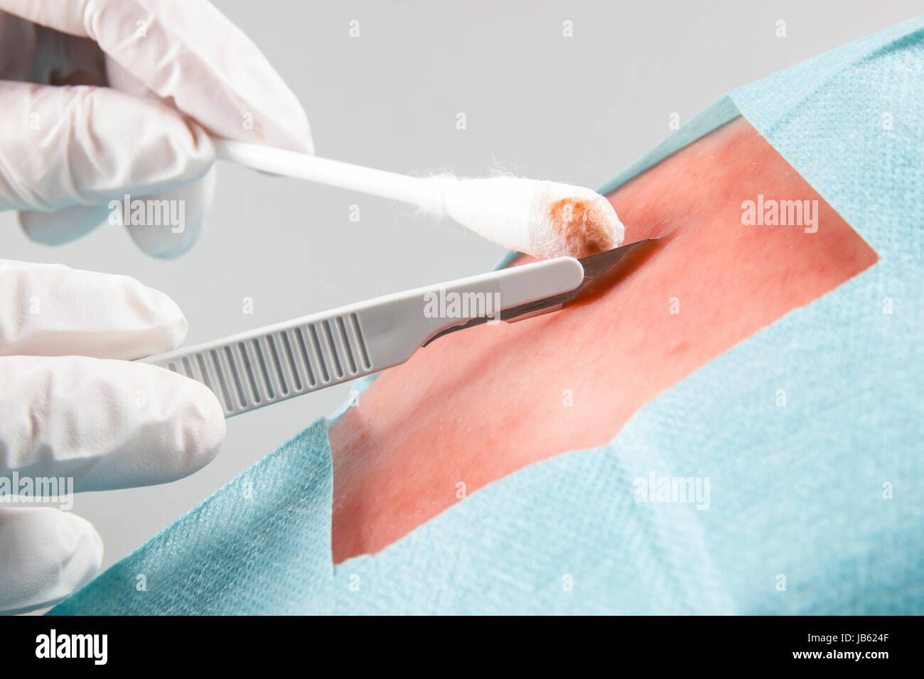 op with a scalpel and pledgets Stock Photo - Alamy