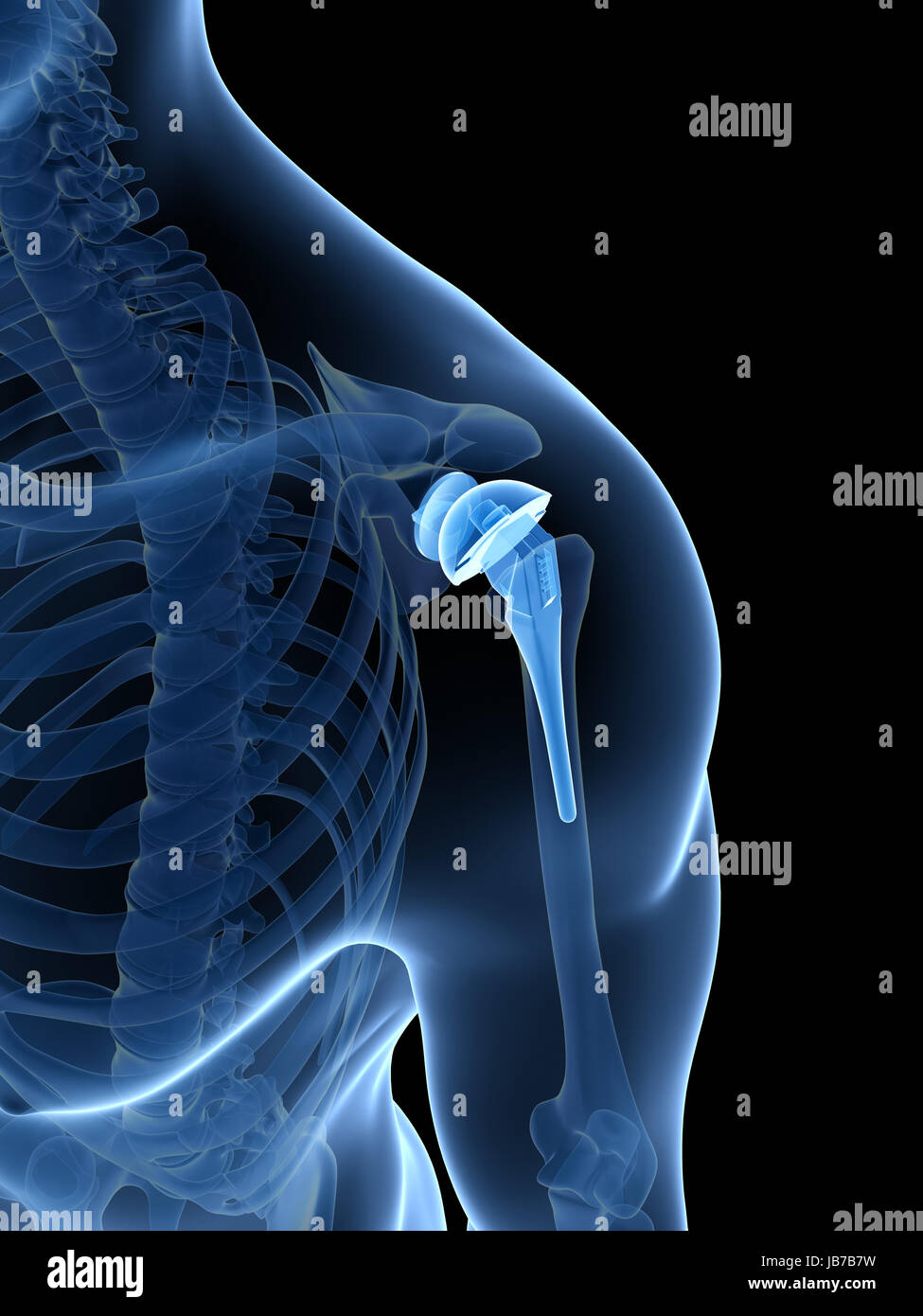 3d rendered illustration of a shoulder replacement Stock Photo - Alamy