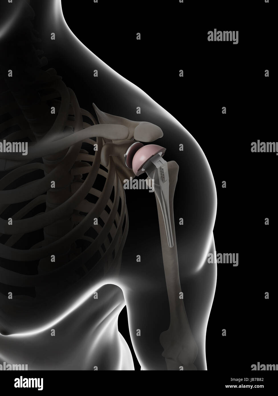 Shoulder implant hi-res stock photography and images - Alamy