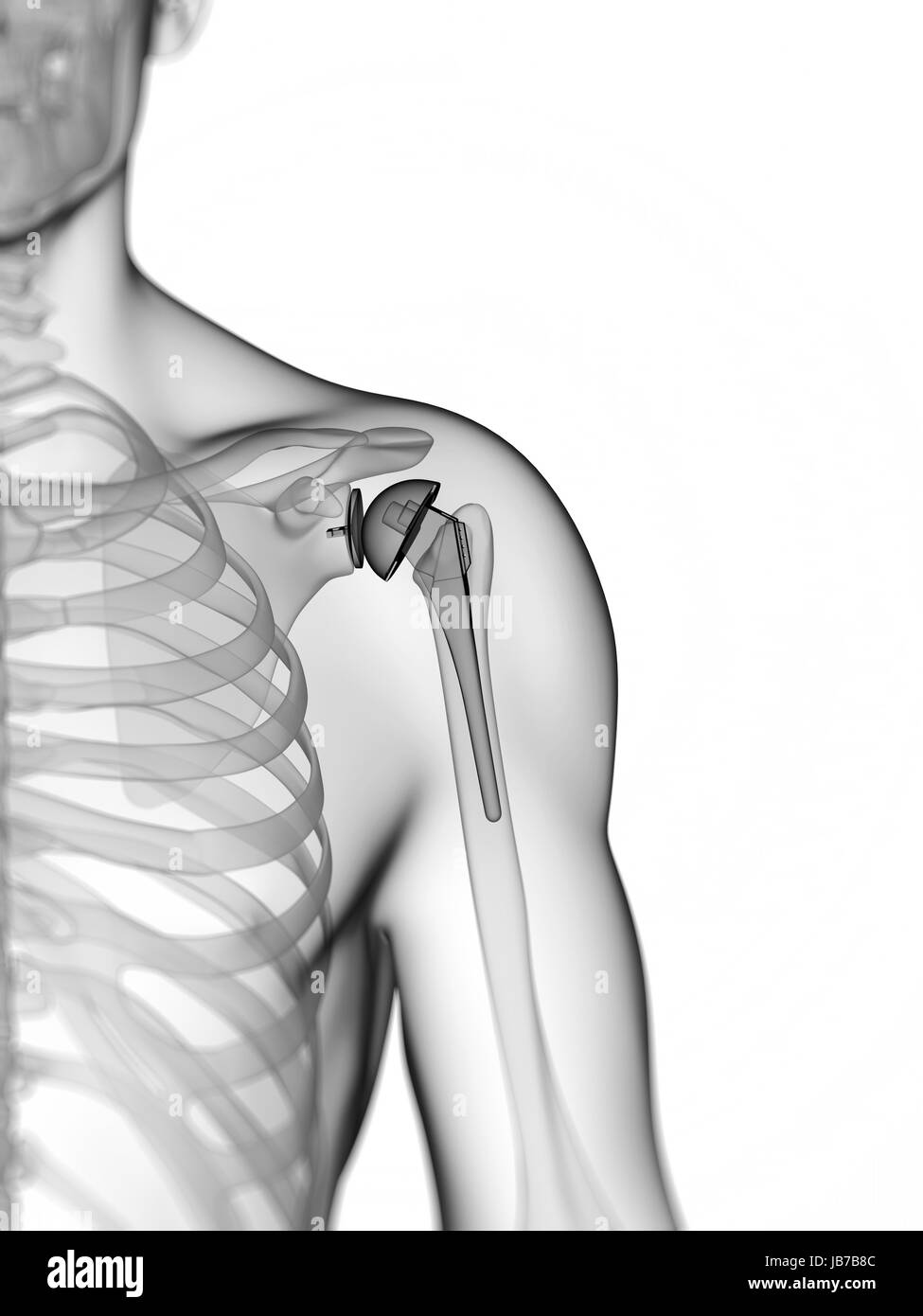 Human shoulder replacement Black and White Stock Photos & Images - Alamy