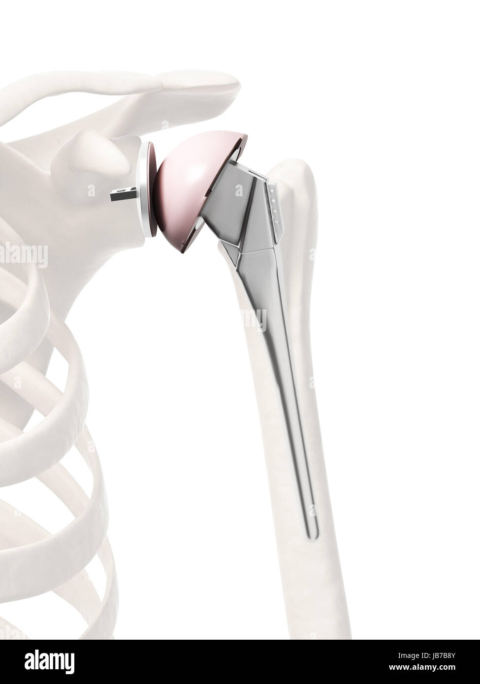 Human shoulder replacement hi-res stock photography and images - Alamy