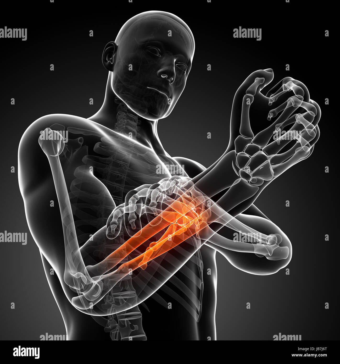3d rendered illustration - painful arm Stock Photo - Alamy