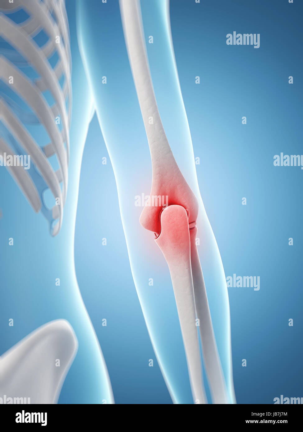Inflamed elbow hi-res stock photography and images - Alamy