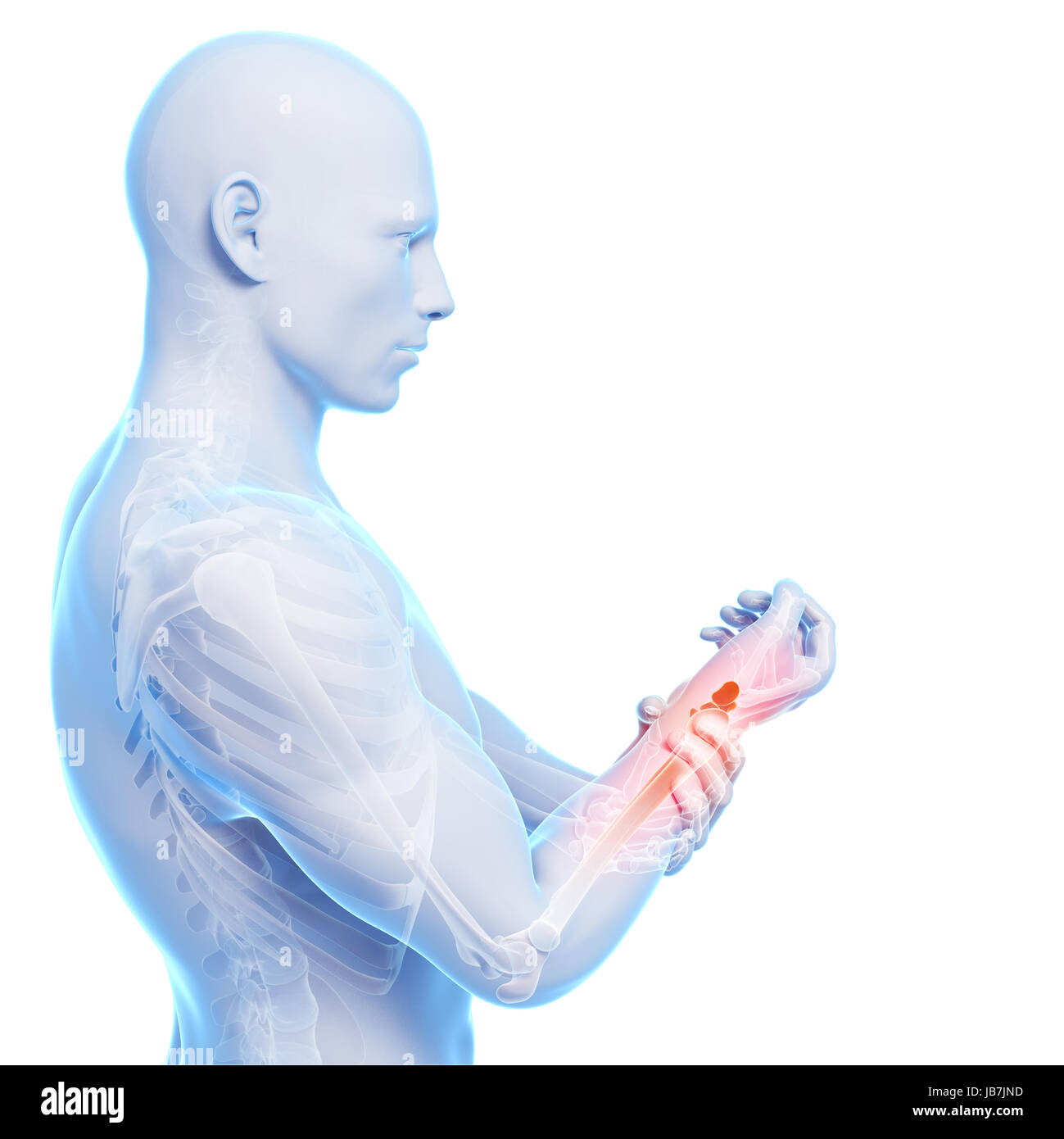 3d rendering illustration cartilage wear injury rheumatism 3d Cut Out ...
