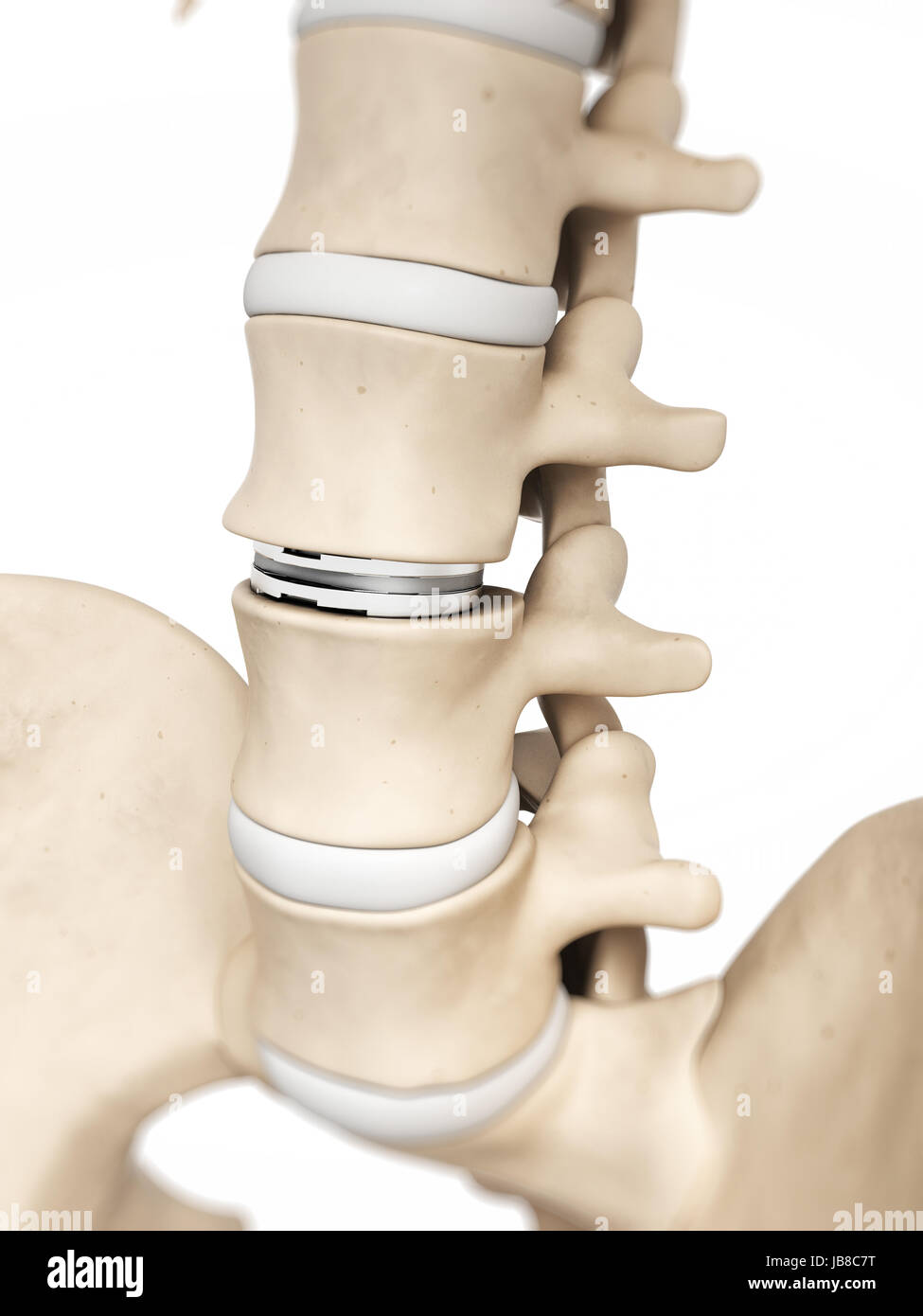 Artificial disc replacement hi-res stock photography and images - Alamy